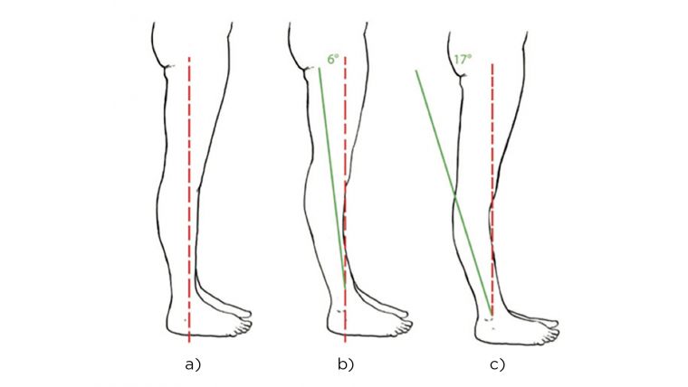 I Hyperextend My Knees: Is This Bad? (Probably Not.)